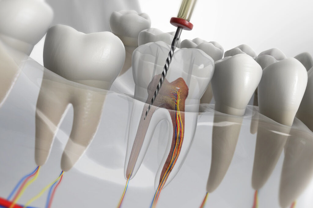 Root Canals – Noho Dental Arts